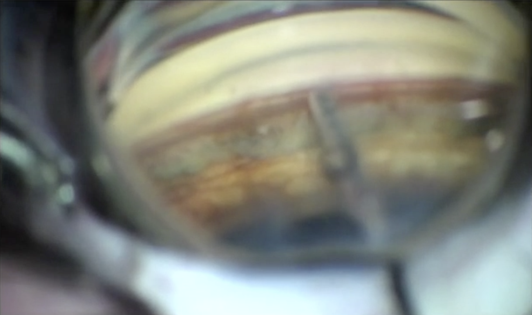 Procedure Using iAccess and iStent inject W - Eyetube